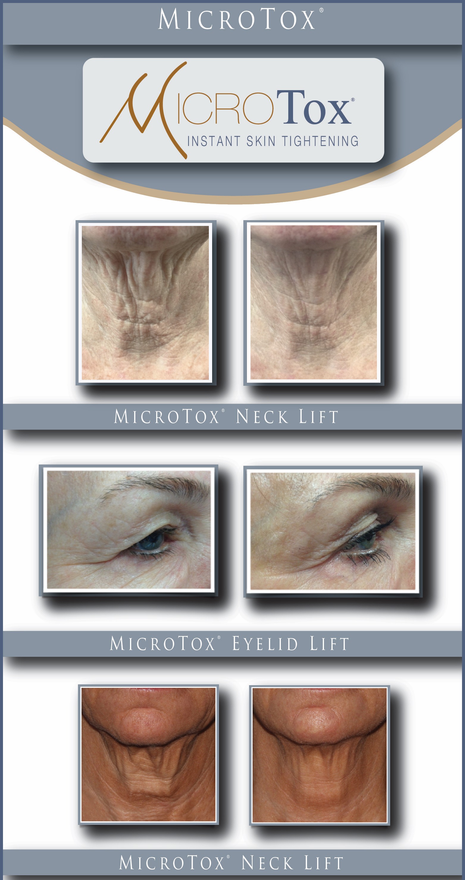 Microtox Instant Skin Tightening And Lifting Palm Springs Medical Spa