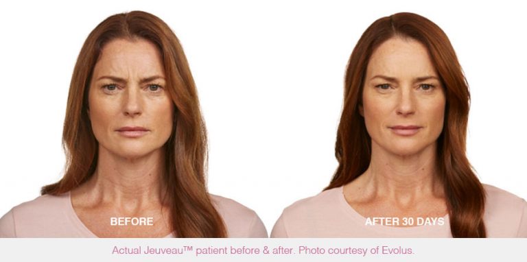 Jeuveau Injections Before After Photos | Wrinkle Reduction | Palm ...