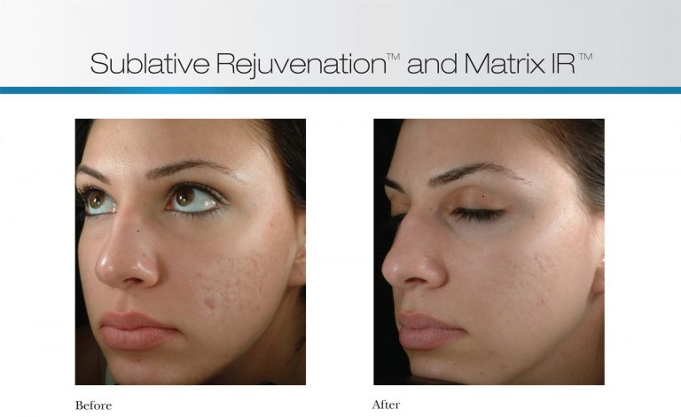 eMatrix Skin Rejuvenation Cost | Reduce liver spots | Palm Springs ...
