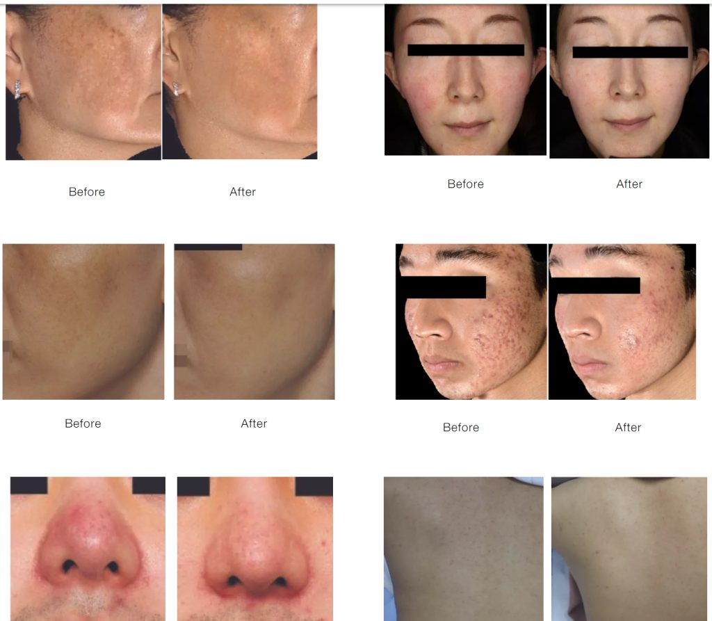 EXOSOME Treatments Before After Photos | Palm Springs, Palm Desert CA